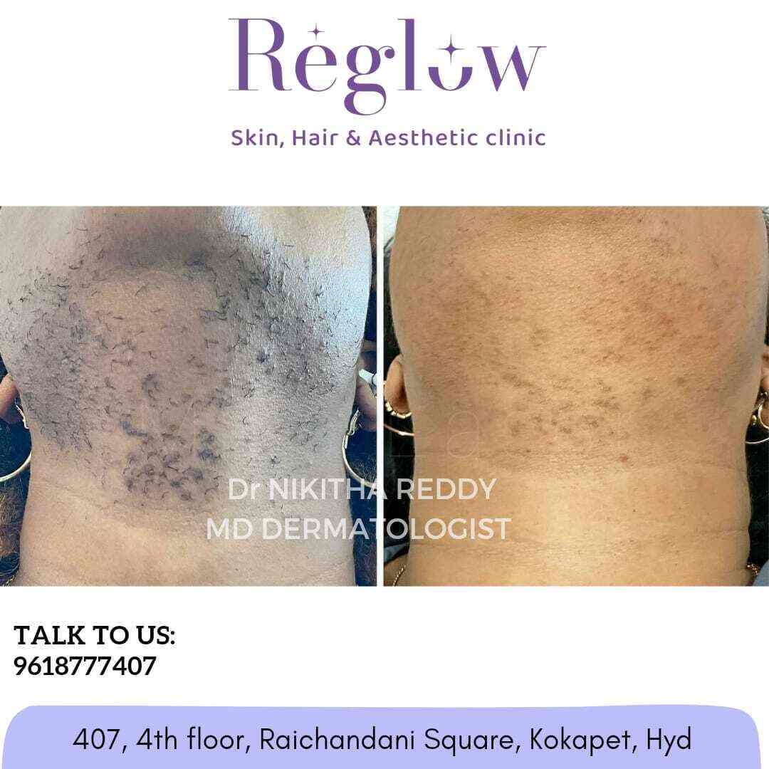 Reglow Skin Hair & Aesthetic Clinic in Kokapet,Hyderabad - Book ...