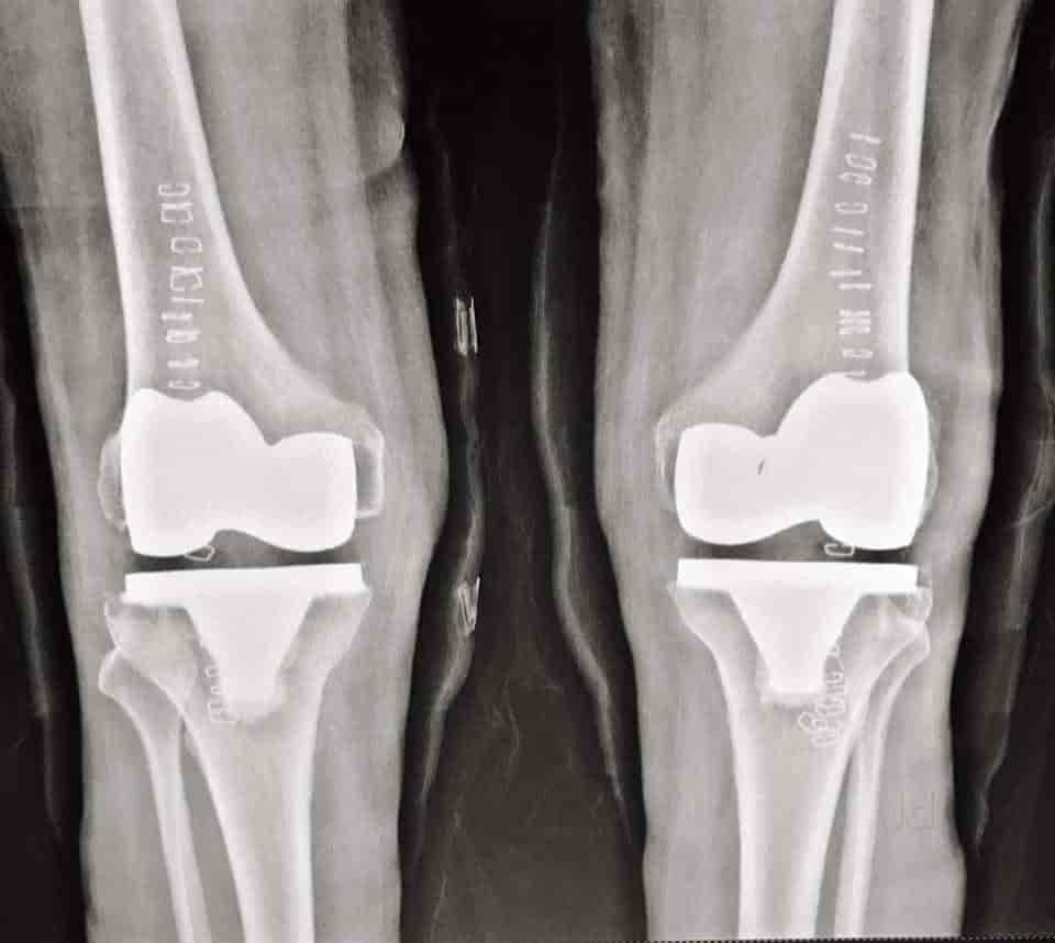 Dr Jay Kumar Sharma in Madhav Nagar,Ujjain - Best Joint Replacement ...