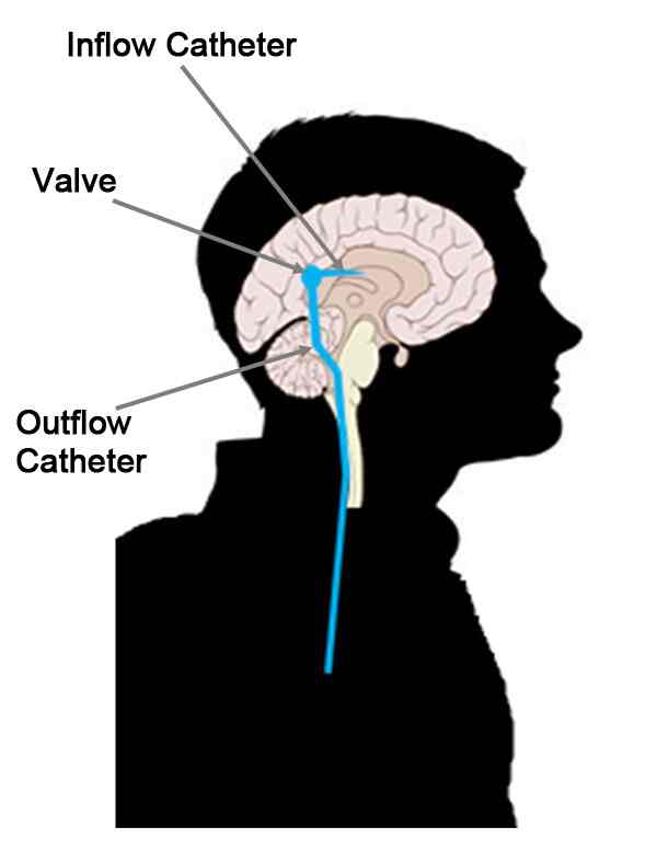 Hydrocephalus Shunt Valve - Get Best Price from Manufacturers ...