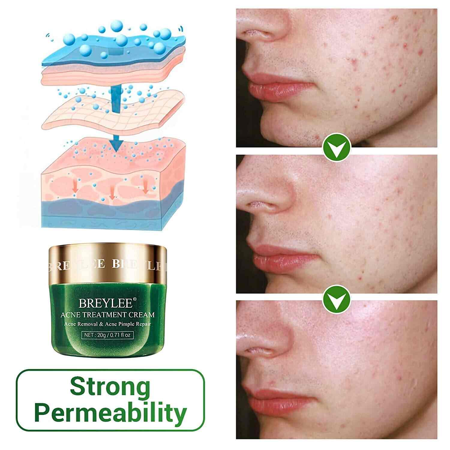 Oily Skin Pimple Cream Get Best Price from Manufacturers Suppliers in India