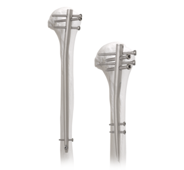 HCM Orthocare Humerus Nail Price Starting From Rs 2/Pc | Find Verified ...