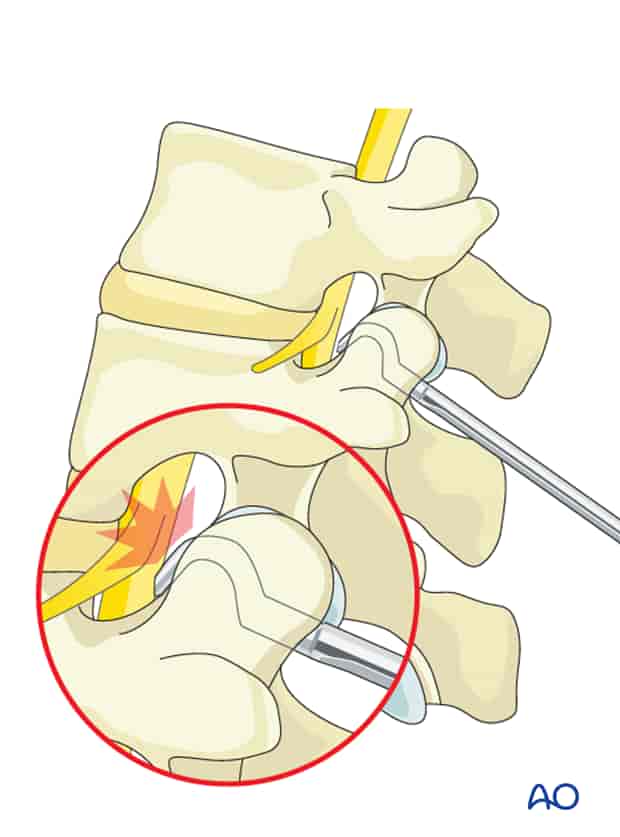 Spinal Hook - Innovative Support Tool for Spine Care - Justdial Verified