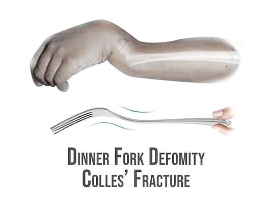 dinner fork deformity nerve