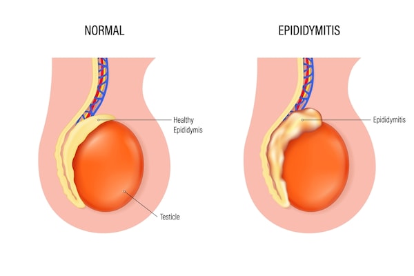 epididymitis causes